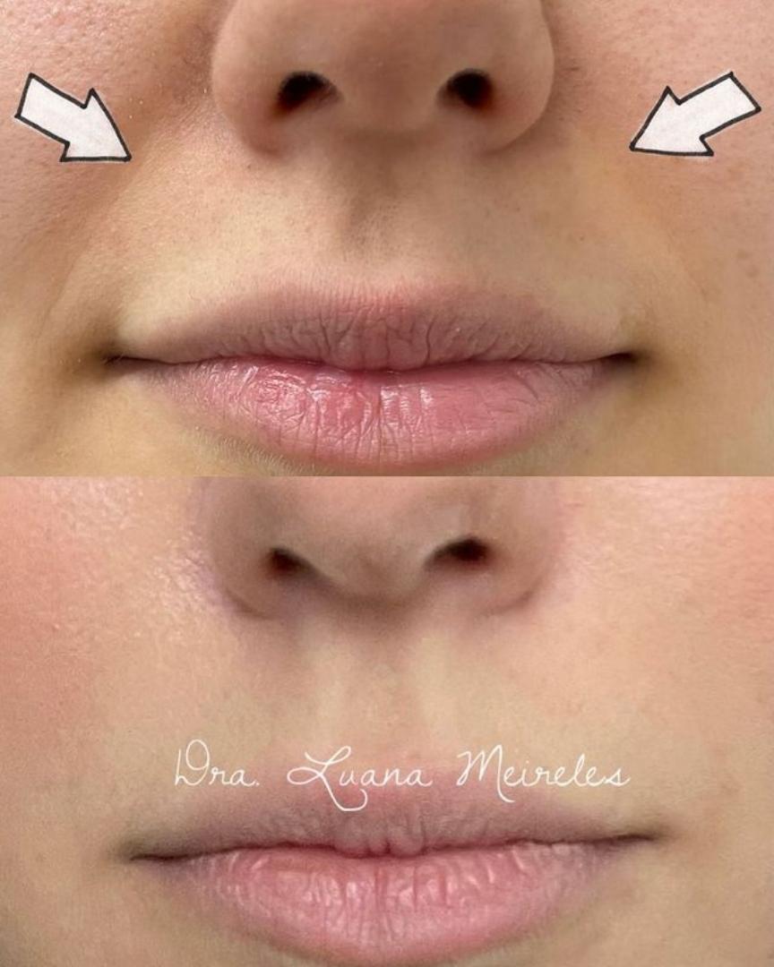 Preenchimento do Mento (Queixo) - Dra. Luana Meireles - Agende sua ...
